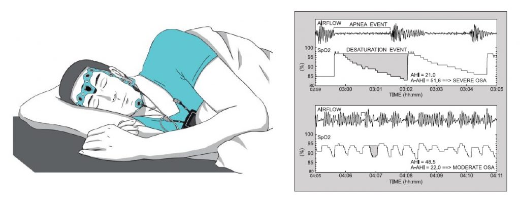 OSA Diagnostics - Sleep Technology & Analytics Research group